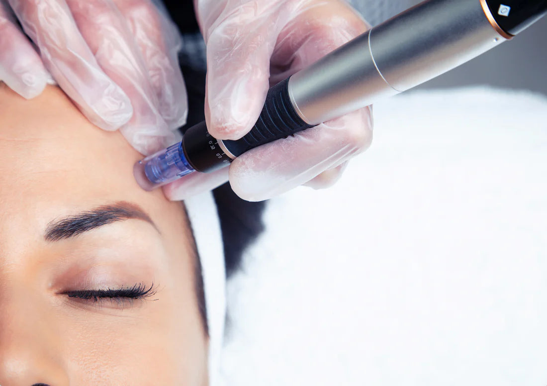 Micro-Needling Facial Treatment – Vail Skin And Lashes | Medical Spa