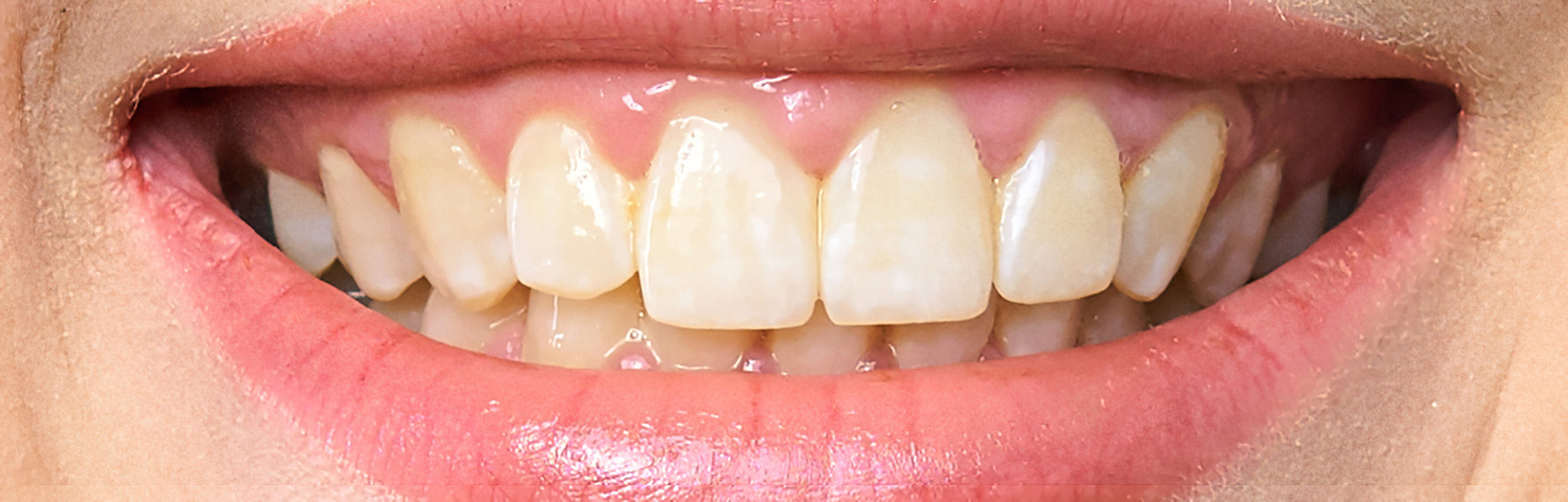 Da Vinci Teeth Whitening Services – Vail Skin And Lashes | Medical Spa